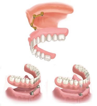 Dentures vs Implants | Smile Bright Dentures